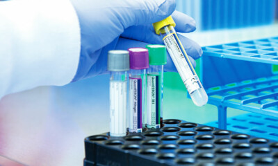 QuantiFERON-TB Gold Plus now performed as in-house testing | Aculabs Inc